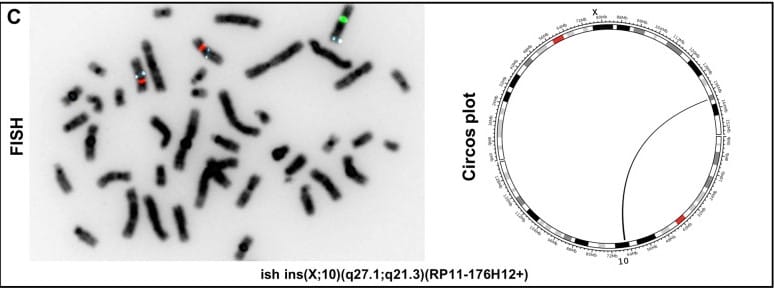 Plott syndrome caused by an interchromosomal insertion - Empire Genomics